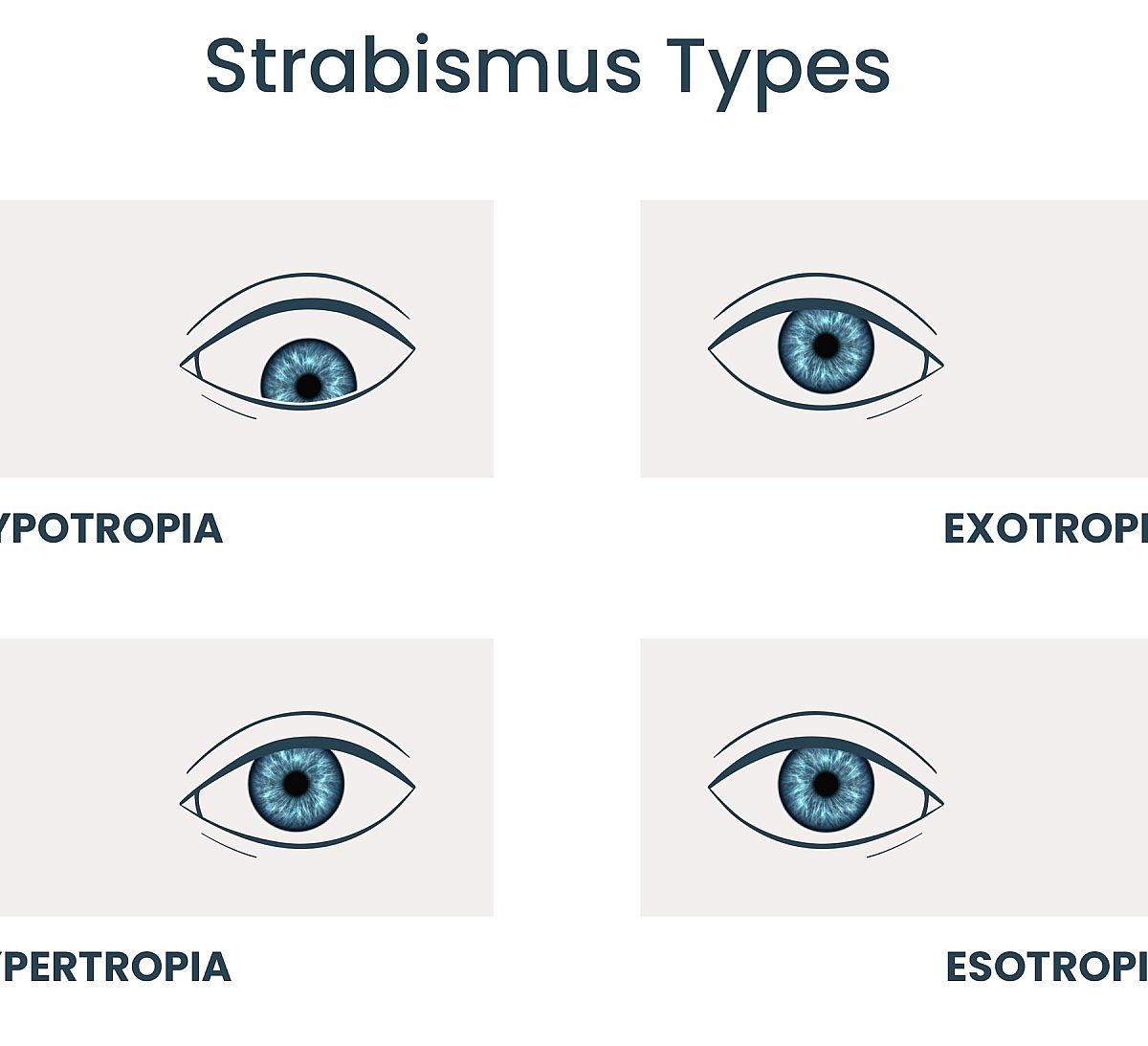 Strabismus: Symptoms, Causes and Treatments | Cure Blindness Project