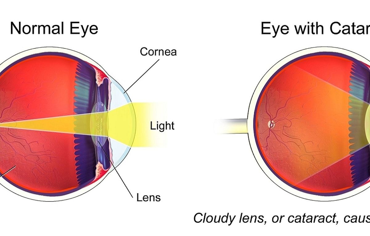 Cataracts: Symptoms, Causes and Treatments | Cure Blindness Project