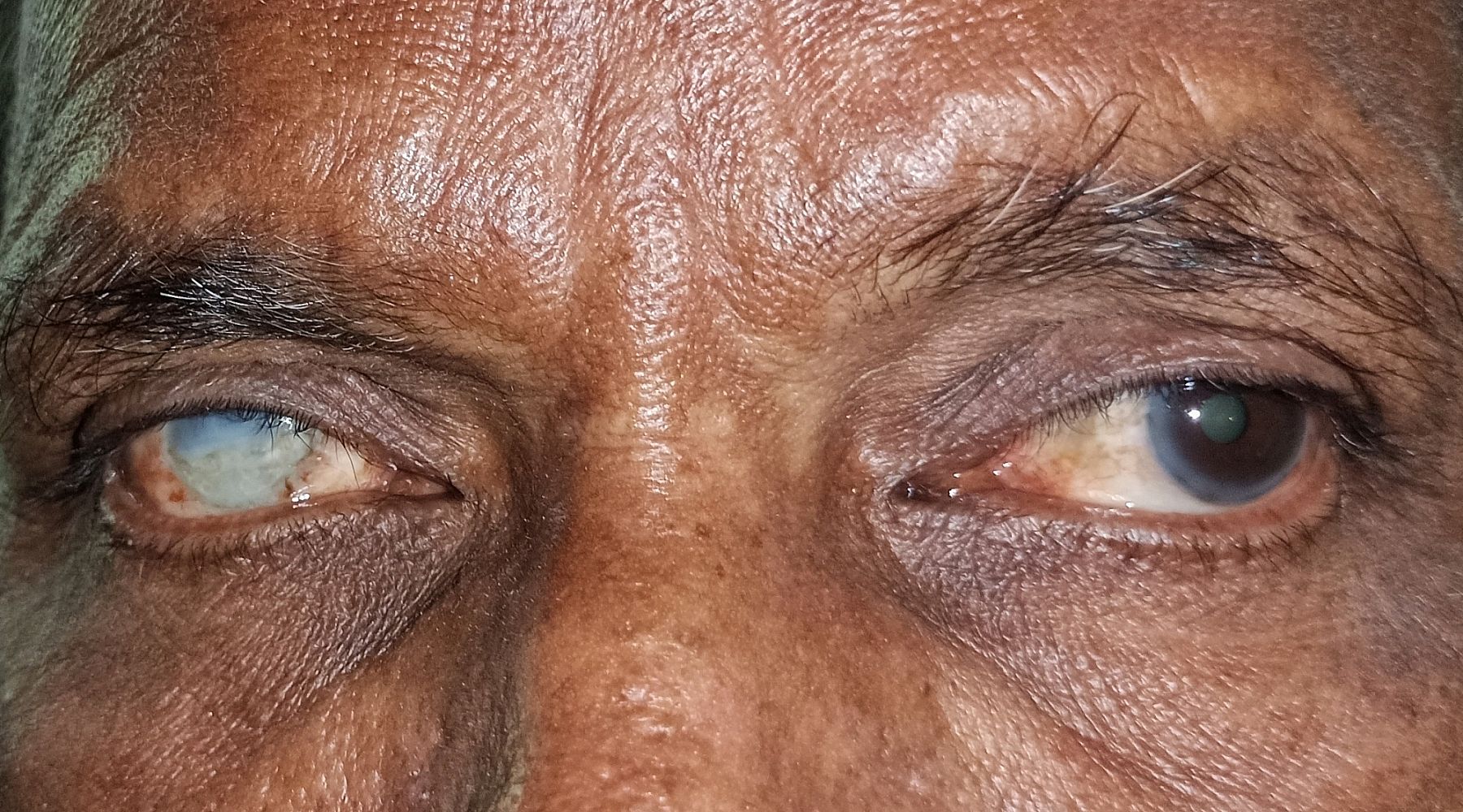 Corneal Transplants: When They’re Needed | Cure Blindness Project