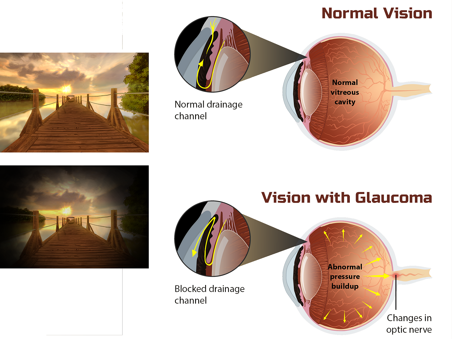 Glaucoma: Symptoms, Causes and Treatments | Cure Blindness Project