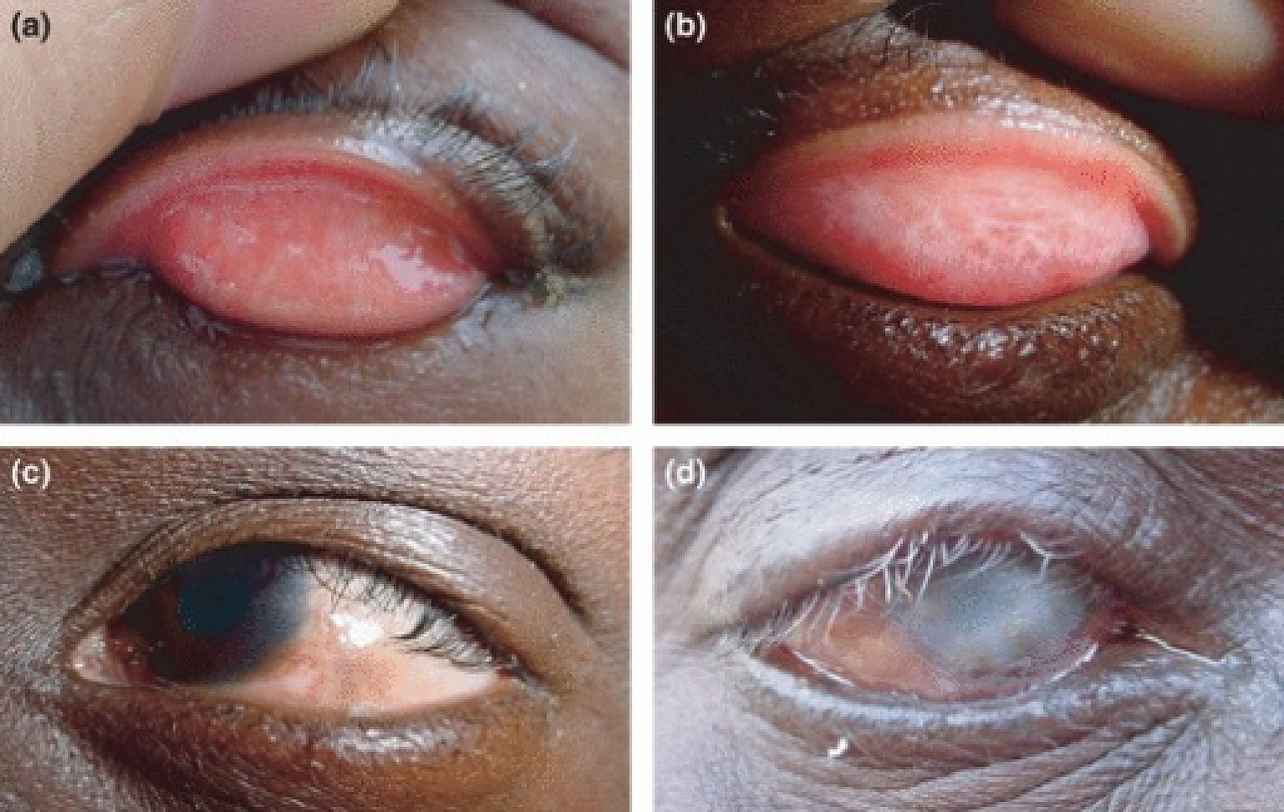 What is Trachoma? | Cure Blindness Project