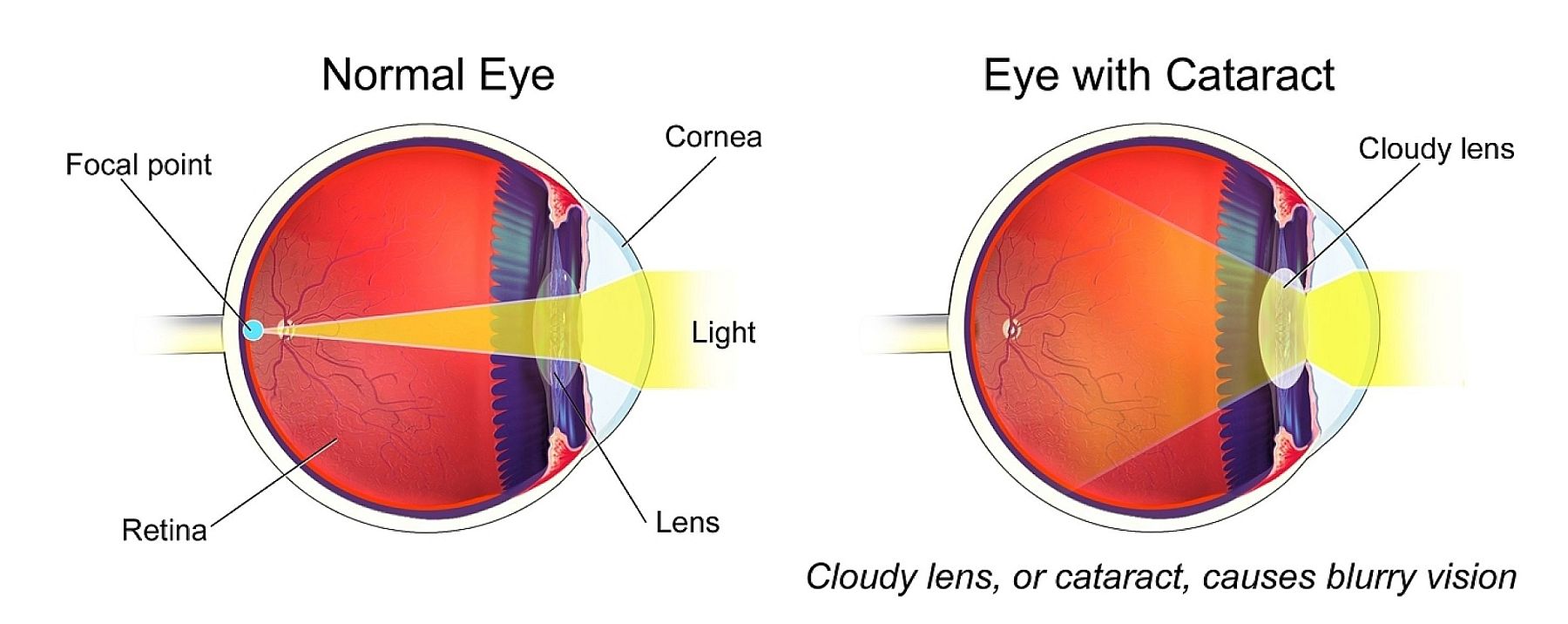 Cataracts: Symptoms, Causes and Treatments | Cure Blindness Project