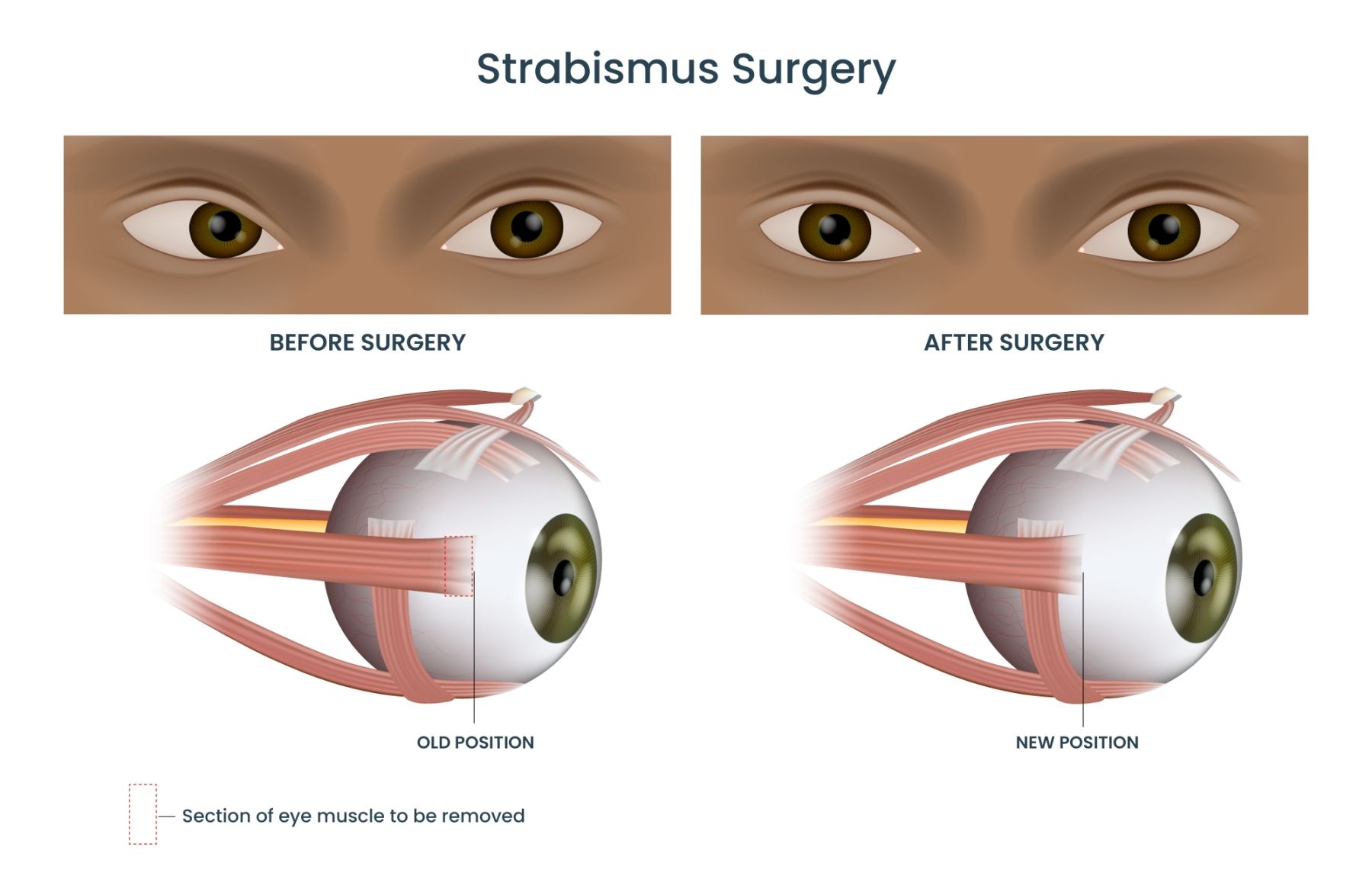 Strabismus: Symptoms, Causes and Treatments | Cure Blindness Project