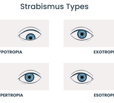 Strabismus: Symptoms, Causes and Treatments | Cure Blindness Project