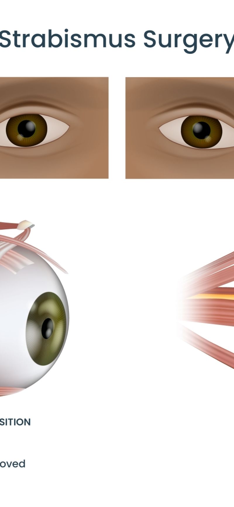 Strabismus: Symptoms, Causes and Treatments | Cure Blindness Project