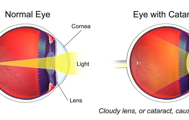Cataracts: Symptoms, Causes and Treatments | Cure Blindness Project