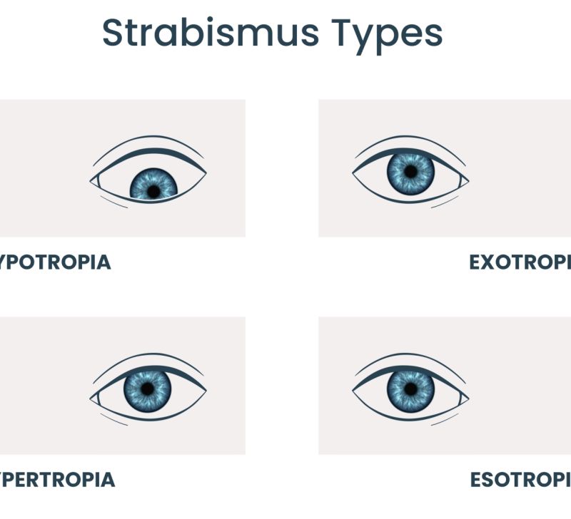 Strabismus: Symptoms, Causes and Treatments | Cure Blindness Project